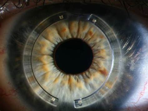 Corneal Remodeling Parker Cornea