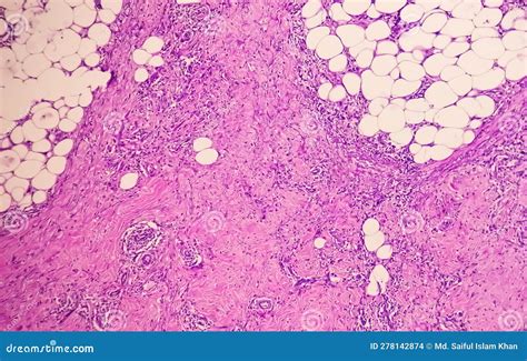 Photomicrograph Of Granulomatous Tissue Histology Royalty Free Stock