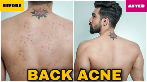How To Get Rid Of Bacne Scars Back Acne Treatment Alinea Medical Spa