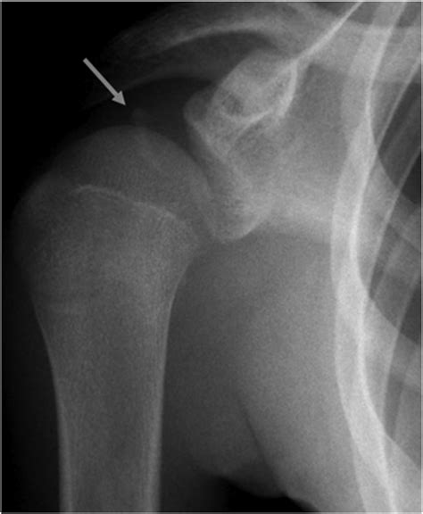 Right Shoulder Anteroposterior Radiograph Shows An Osteochondral
