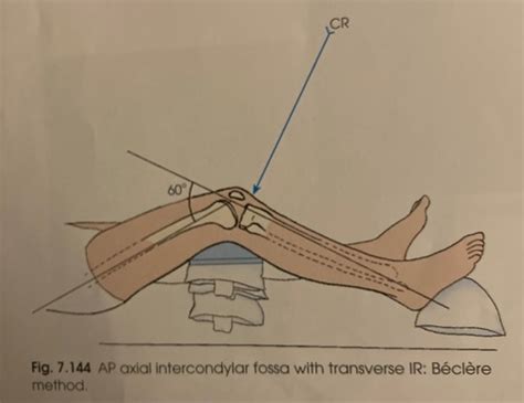 Ap Axial Projection Of The Intercondylar Fossa Beclere Method