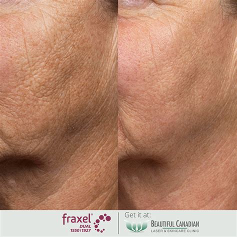 Vancouver Fraxel® Dual Laser In Surrey Skin Tone And Anti Aging