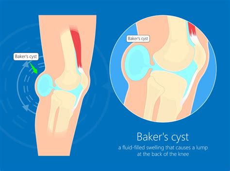 Bakers Cyst Treatment And How To Sleep With A Bakers Cyst