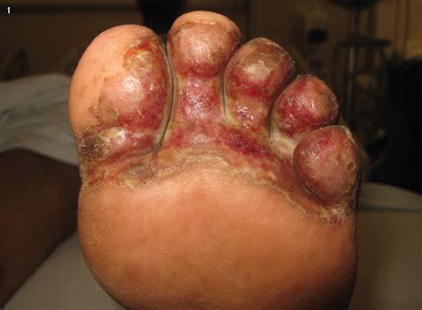 Bacterial Toe Web Infection Consultant360