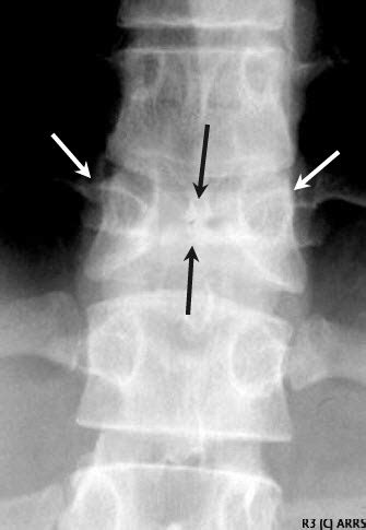 Welcome To Learningradiology Radiology Radiologic Imaging Signs