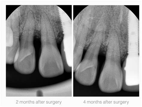 Periodontal Defect 2 Ti Oss