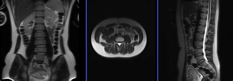 Lumbar Lumbosacral Spine Mri Planning And Protocols Indications For