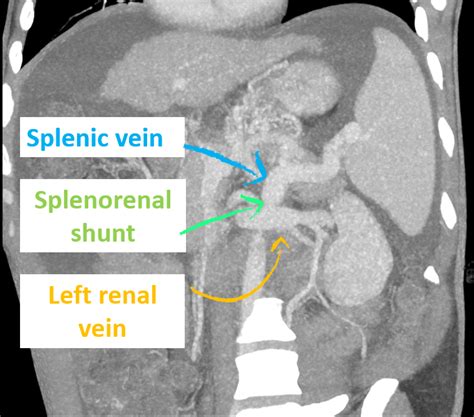 Splenorenal Shunt