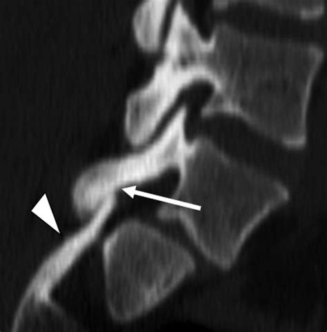 Unilateral Facet Dislocation