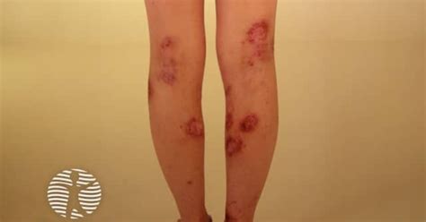 Nummular Dermatitis Discoid Eczema Image