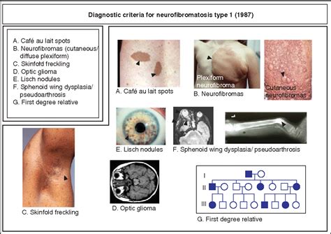 Neurofibromatosis Type 1 Lisch Nodules