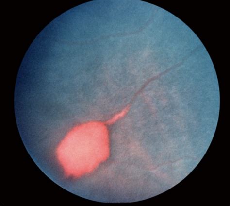 Sickle Cell Disease Flashcards Quizlet Sickle Cell Disease Flashcards Quizlet