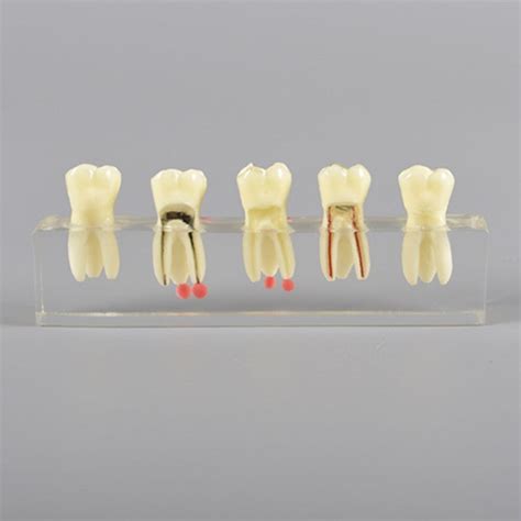 W4012 Dental Root Canal Model With Restoration