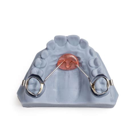 Llha Lower Lingual Holding Arch Motif Orthodontic Arts