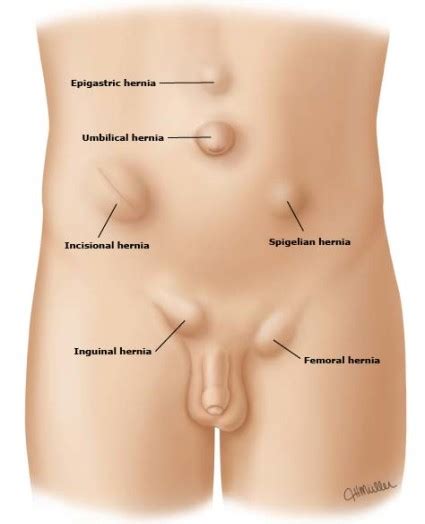 Hernia
