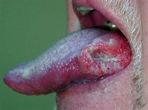 White Spots On Tonsils Std