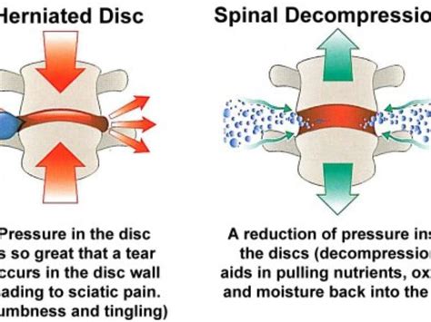 Self Spinal Decompression
