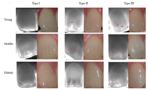 Infrared Clinical Enamel Crack Detector Based On Silicon Ccd And Its