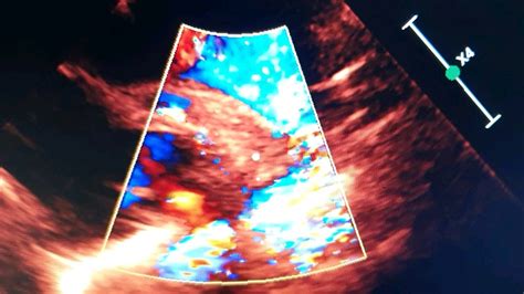 Nurun Nahar Fatema On Linkedin Echo Showing Excellent Flow Through Pda Stent Of Case Performed