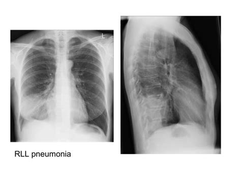 Chest X Rays Basic Interpretation Ppt