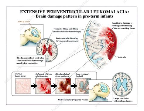 Periventricular Leukomalacia Illustration Stock Image C0593411 Science Photo Library