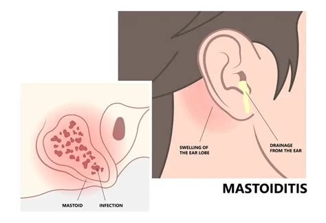 What Is Mastoiditis Causes Symptoms Treatment