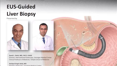 Eus Guided Liver Biopsy Broadcastmed