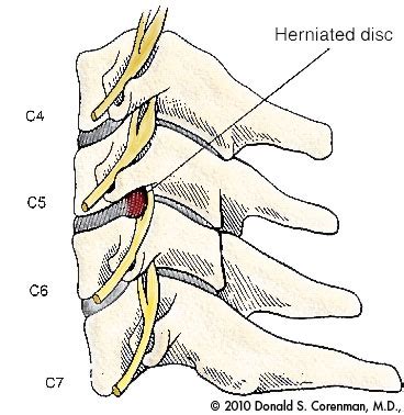 Cervical Degenerative Disc Disease Spine Specialist
