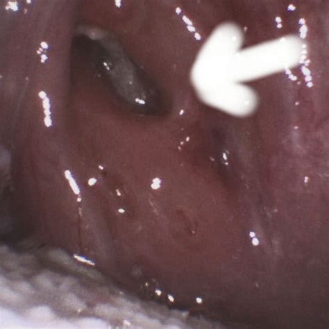Tonsil Stones Bad Breath Tonsillitis
