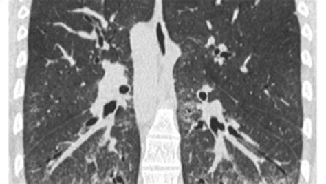 Scleroderma Associated Ild Case Study Ild Radiology Rounds