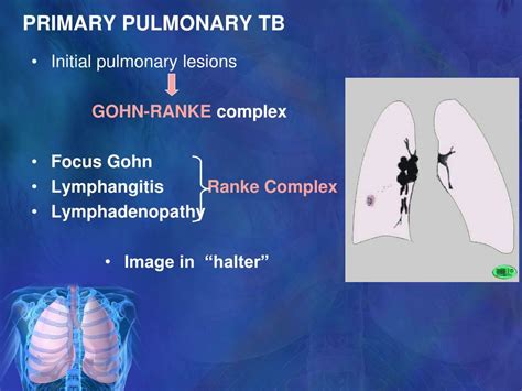 Ppt Pulmonary Tuberculosis Radiological Images Powerpoint