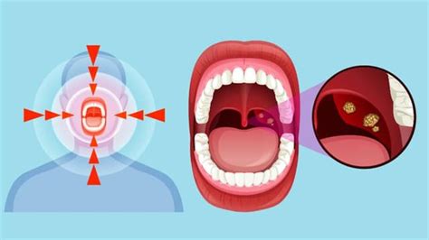 Am I At The Risk Of Tonsillitis The Wellness Corner