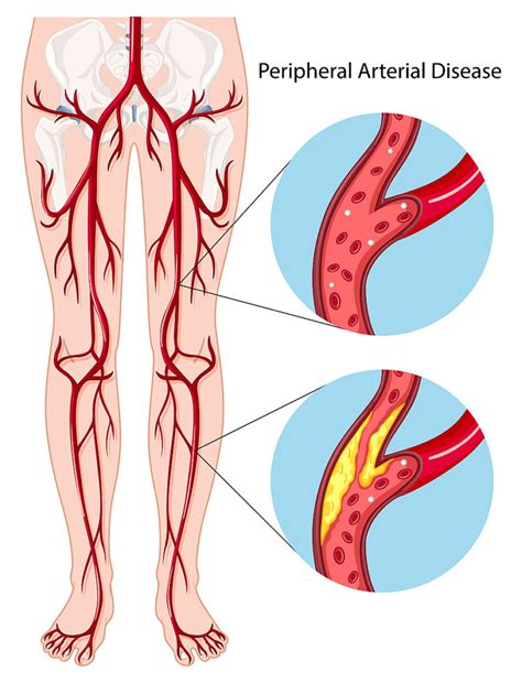 What Are Vascular Diseases At Carole Alden Blog