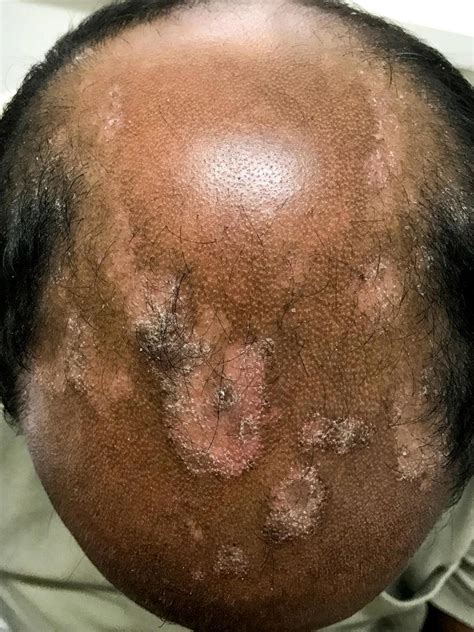 How To Tell If You May Have Scalp Psoriasis Vs Dandruff