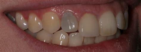 Internal Bleaching In Del Mar And Rancho Santa Fe