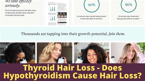 Hair Loss Thyroid Disease At Cynthia Brandenburg Blog