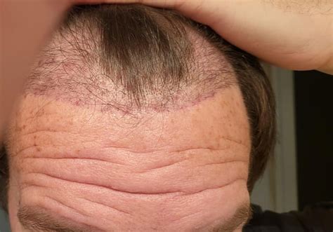 3 Month Update Hmr Dr Cortez Rhairtransplants