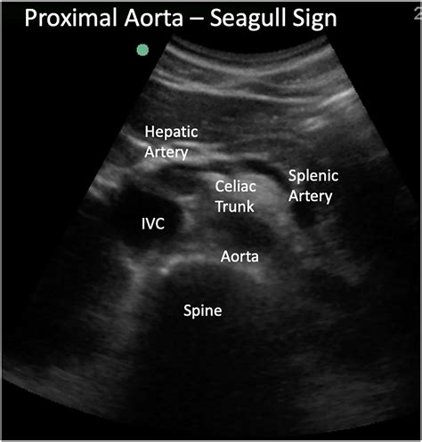 Abdominal Aorta Ultrasound Anatomy