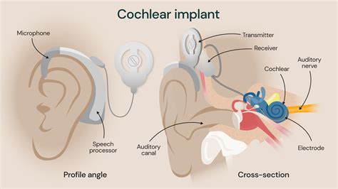 World Class Care In Paediatric Hearing Implant Surgery