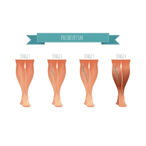 Premium Vector Phlebology Infographic Treating Varicose Veins