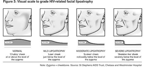 Hiv Lipodystrophy And Your Quality Of Life