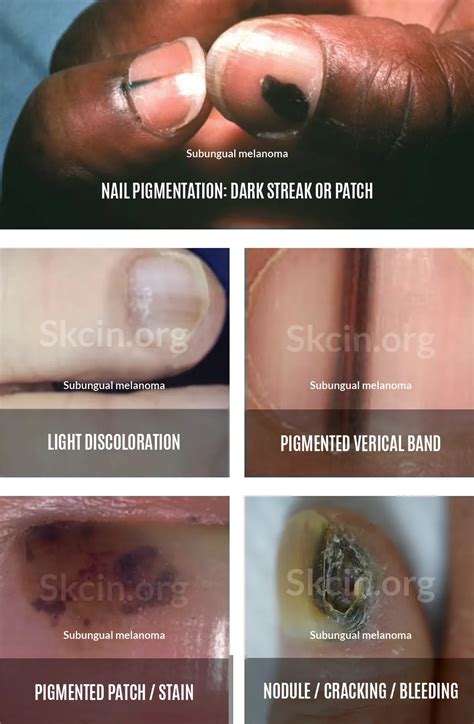 Melanoma Subungueal Precoce