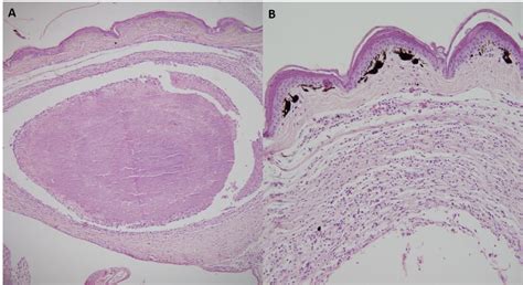 Cyst Lined Black Arrow By Keratinized Epithelium With A Distinct
