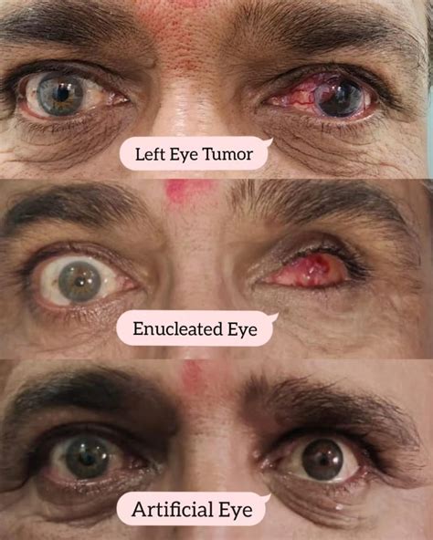 Eyecancer Eyetumor Enucleation Artificialeye Eyeprosthesis Ahmedabadoculoplastics