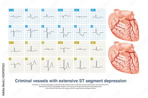 Poster In Case Of Acute Coronary Syndrome If The Ecg Shows Extensive