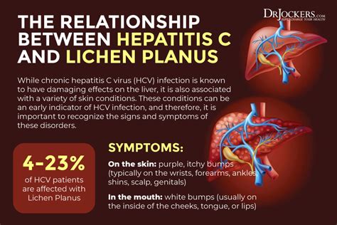 Lichen Planus Symptoms Causes And Support Strategies Ōmura Health