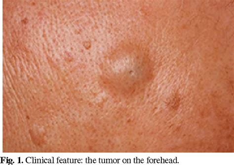 Sebaceous Or Epidermoid Cyst Epidermoid Cyst Tuhtoy
