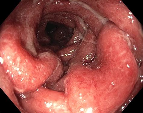 Infectious Colitis Disease