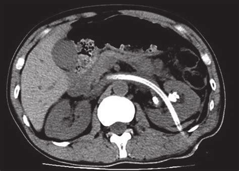 Nephrostomy Location