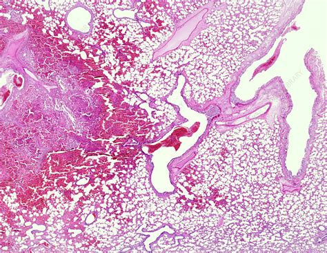 Hepatization Of Lung